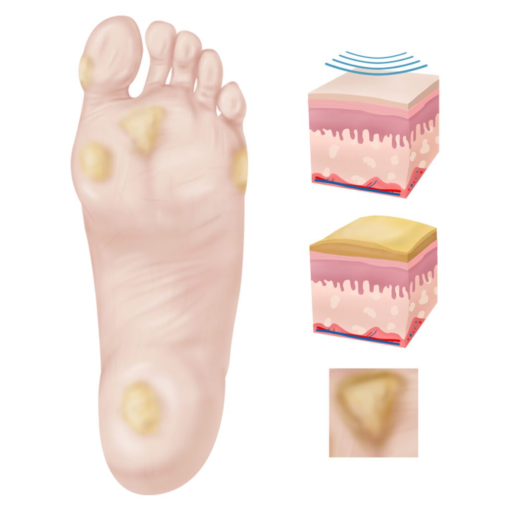 Förhårdnader: symptom och borttagning - Sverige